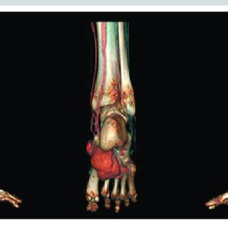 Multiplanar Computed Tomography CT Reconstruction Detailed Legend
