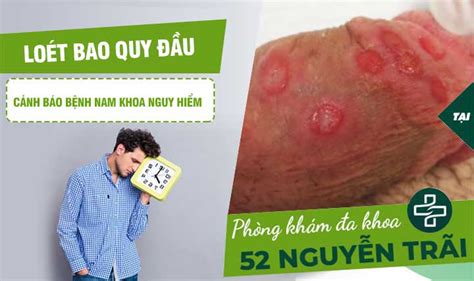 Loét bao quy đầu Dấu hiệu bệnh nam khoa nguy hiểm ở nam giới