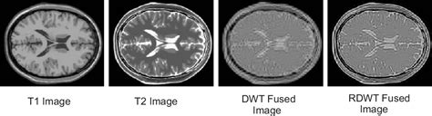 figure 3 from multimodal medical image fusion using redundant discrete wavelet transform