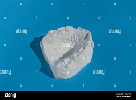 Dental Casting Gypsum Model Plaster Cast Stomatologic Human Jaws