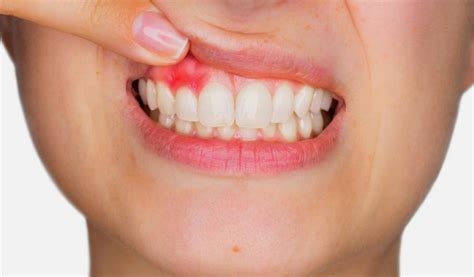 Infecciones Bucales Mas Comunes