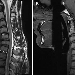 A Preoperative Sagittal T2 Weighted Magnetic Resonance MR Image