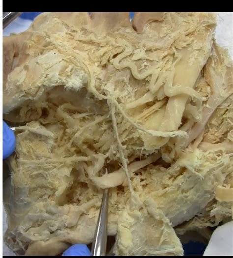 Infratemporal Region Diagram Quizlet
