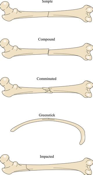 Drawing Of Closed Fracture And Open Fracture Royalty Free Images Stock