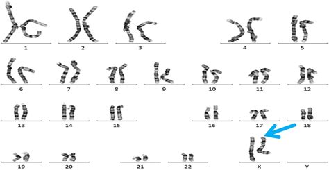 Abnormalities Genetic Karyotype Karyotypes Chromosome Chromosomal