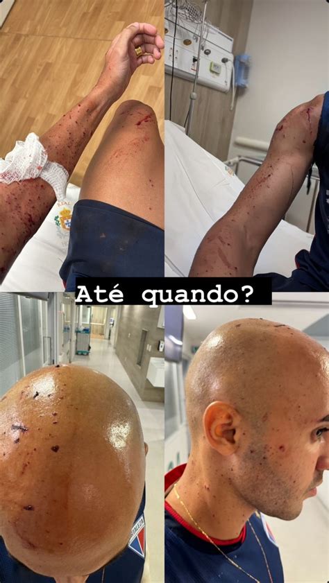 Ex Inter desabafa após se ferir em ataque contra ônibus do Fortaleza