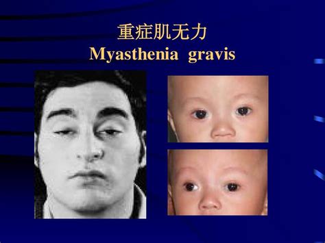 终于找到重症肌无力久治不愈的原因都是饮食不当 微医挂号网