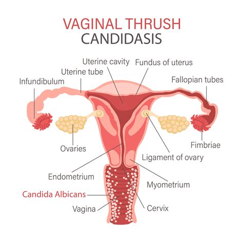 Vaginal Hongos Infecci N Candidiasis Infografia De Ginecol Gico