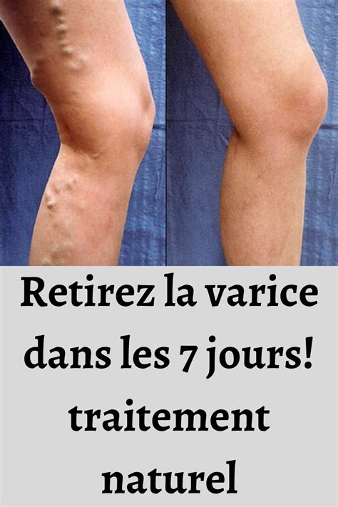 Retirez La Varice Dans Les 7 Jours Traitement Naturel En 2020 Varice