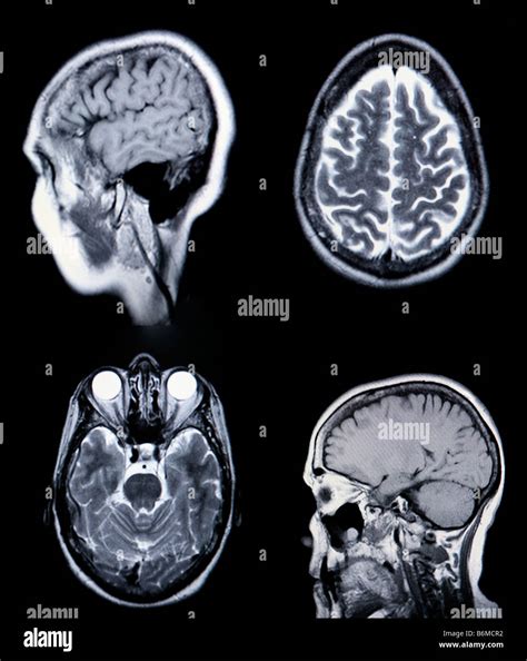 Resolution Ct Of The Human Brain Hi Res Stock Photography And Images