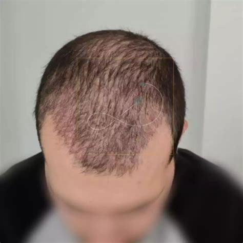 Nos résultats de greffe de cheveux mois par mois chez Klineva
