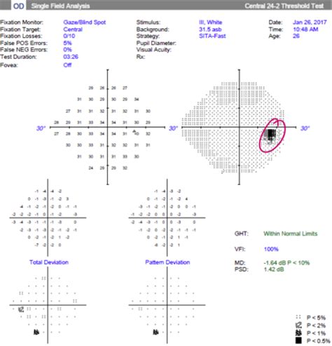 Visual Fields Defects Flashcards Quizlet