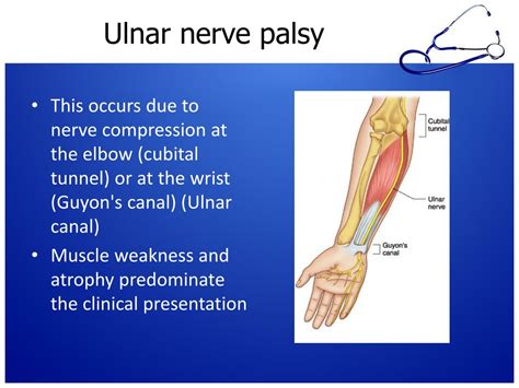 Ulnar Nerve Palsy