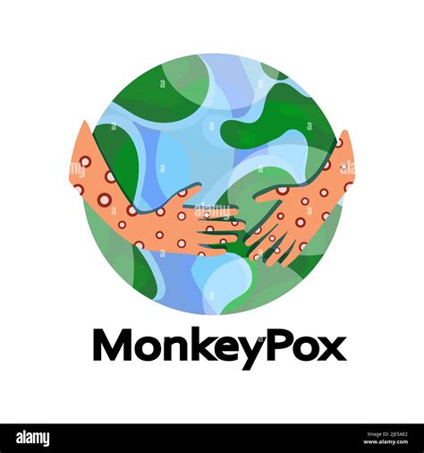 Virus Monkeypox Eruzione Sul Corpo Virus Della Varicella Scimmia