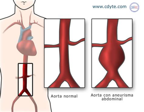 Tratamiento Endovascular Del Aneurisma Abdominal De Aorta