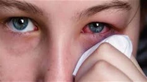Alergia Nos Olhos Sintomas E O Que Fazer YouTube