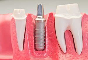 Seguro Dental que cubra implantes halla más coberturas y mejor precio