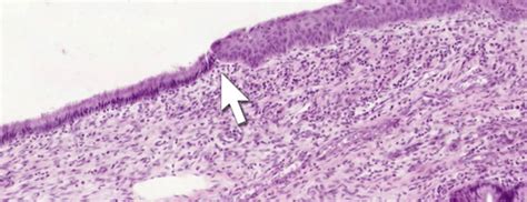 Pathology Of Uterus Cervix Vulva Vagina Flashcards Quizlet