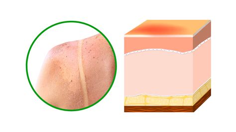 Three Main Layers Of Skin Burns