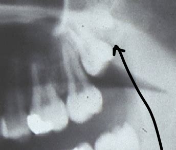 1 2 Abnormalities In Teeth Flashcards Quizlet
