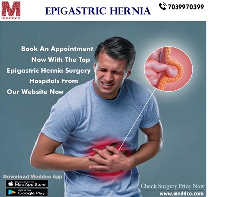 Illustration Of An Epigastric Abdominal Hernia Photograph By John
