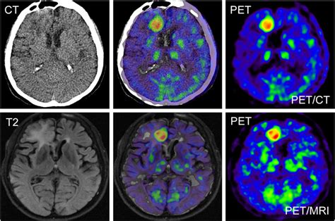 PET CT And PET MRI Images Of 56 Y Old Patient With Glioblastoma