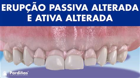 ERUPÇÃO PASSIVA ALTERADA e ativa alterada Consequências e tratamentos