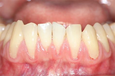 Encías retraídas Causas y tratamiento Gaceta Dental