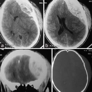 The Cranial Computed Tomography Scan Of The First Patient A And B