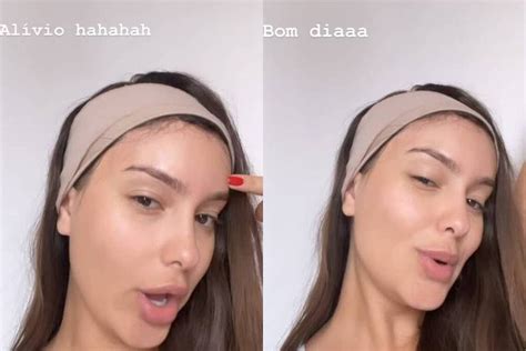 HZ Ex BBB Thais Braz mostra resultado de cirurgia na testa pela 1ª