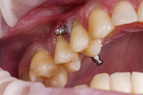 Los Microtornillos En Ortodoncia ARTIS Dental
