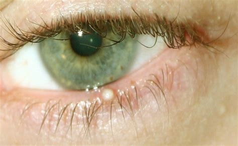 8 Causes Of Eyelid Bumps And How To Get Rid Of Them Med Health Net