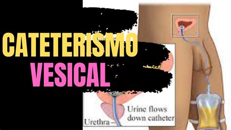 Cateterismo Vesical De Demora Masculino E Feminino Cateterismo