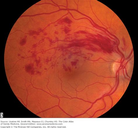 Hypertensive Retinopathy Basicmedical Key
