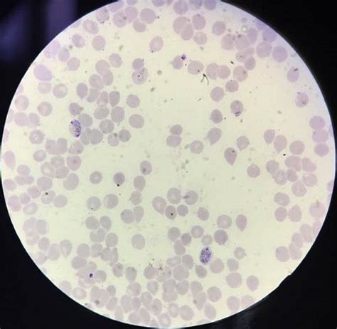 Photomicrograph Of Peripheral Blood Smear Showing Plasmodium Vivax