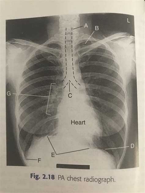 PA Chest Radiograph Labeling Diagram Quizlet