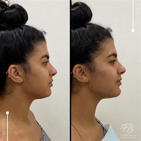 Projeção de Mento Harmonização Facial Dr Fabio Barros Rio de
