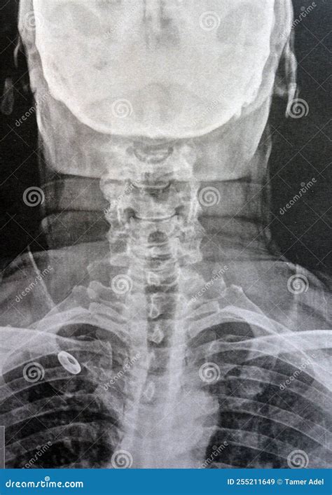 Plain X Ray Cervical Vertebrae Showing Straightening Of Cervical The