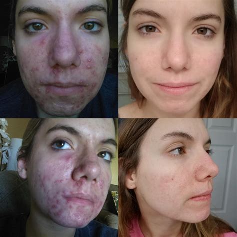 Accutane Before During And After