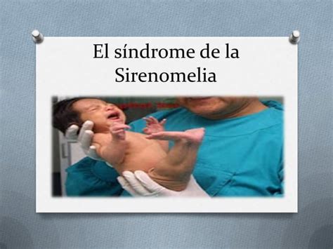 El síndrome de la sirenomelia PPT Descarga Gratuita
