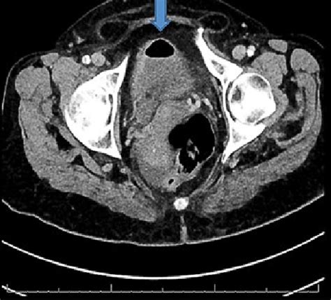 Tomodensitométrie abdominale coupe axiale avec représentation de