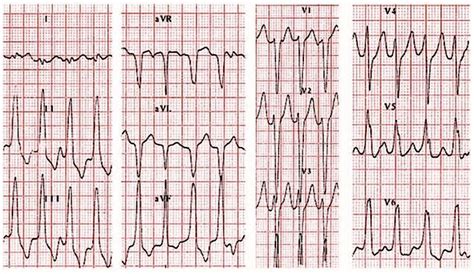 Taquicardia Ventricular Ekg