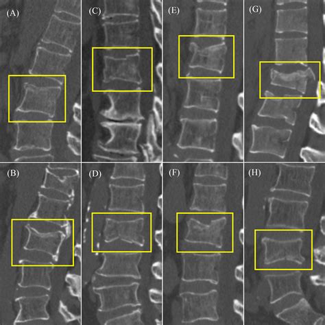 frontiers automated detection and classification of acute vertebral body fractures using a