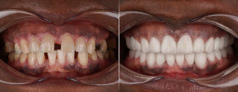 Diastema Causes Types And Treatment Costs Dentakay