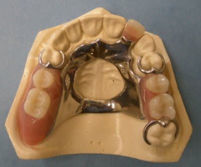 Odontologia carinho Próteses Removíveis