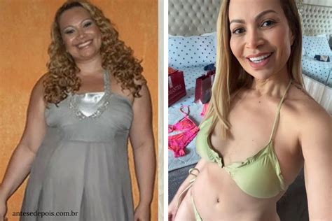 Abdominoplastia Antes E Depois Veja Tudo Que Precisa Saber