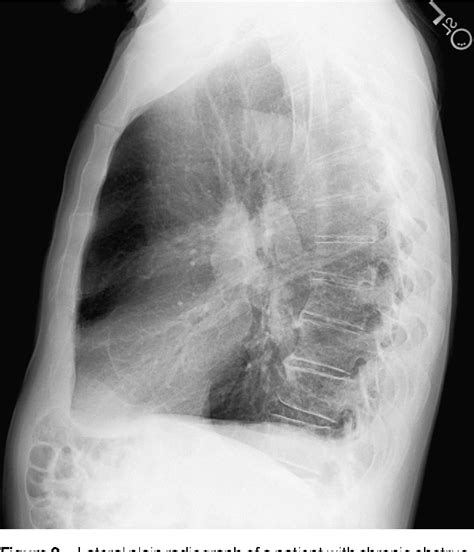 Lateral Chest Radiograph Anatomy