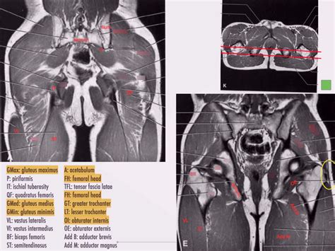 Dxi Pelvis And Hip Coronal Mri Diagram Quizlet