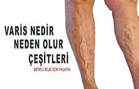 Varis Hakkında Tüm Merak Edilenler Toplardamar Genişlemesi IDEA
