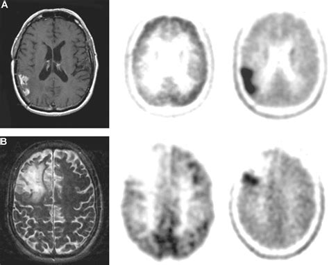 Cellular And Molecular Imaging With Spect And Pet In Brain Tumors